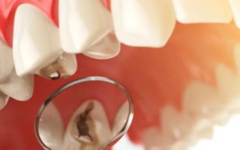 ¿Cuáles son los síntomas de caries? - policlinicarumon.com